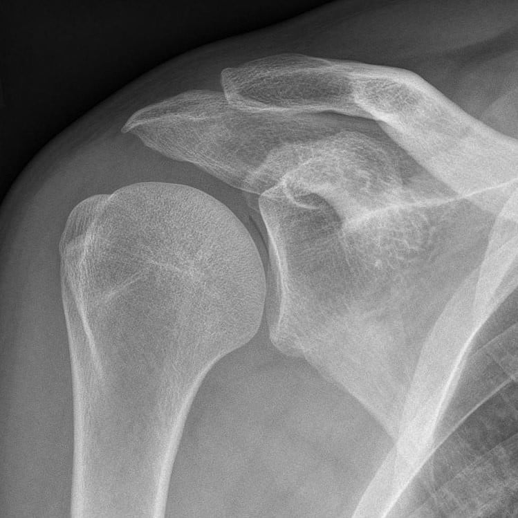 Shoulder Anatomy - The Bodyfix Blueprint